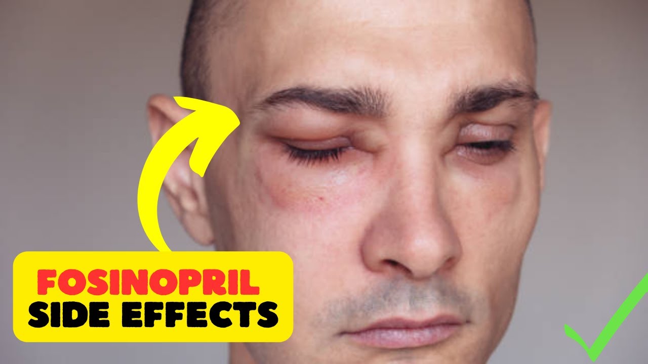 Fosinopril Side Effects: Understanding the Potential Risks and ...