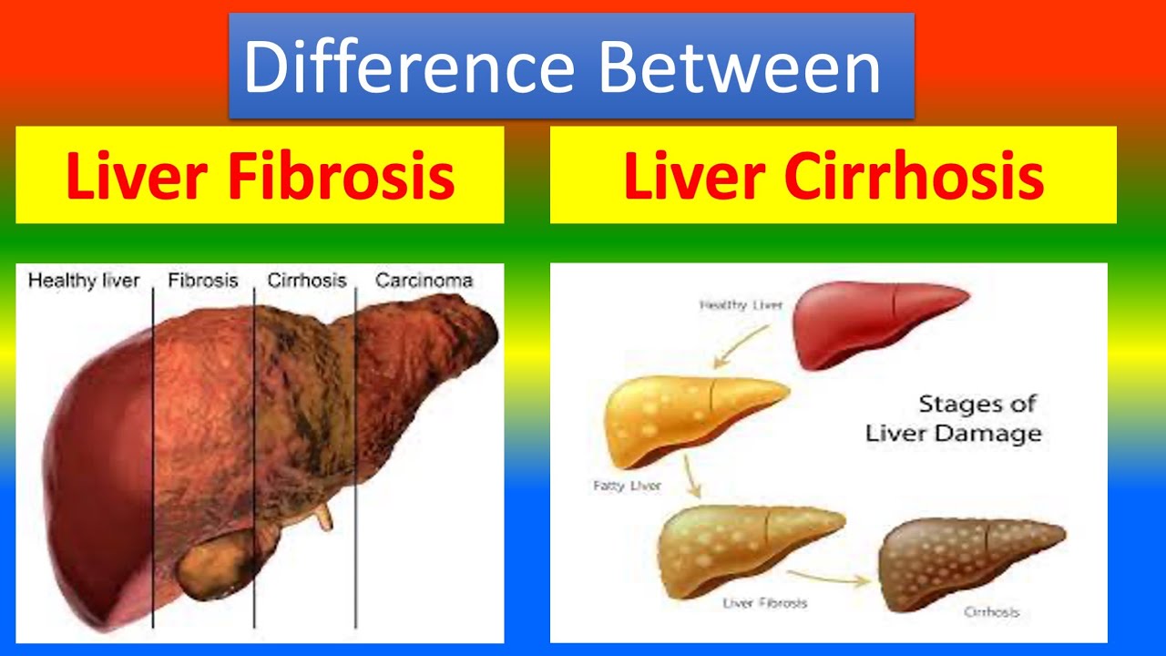 Difference Between Liver Fibrosis And Liver Cirrhosis - YouTube