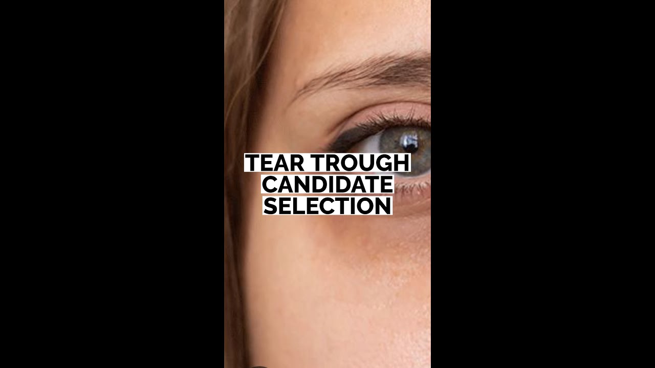 Are You a Good Candidate for Tear Trough Filler? - YouTube