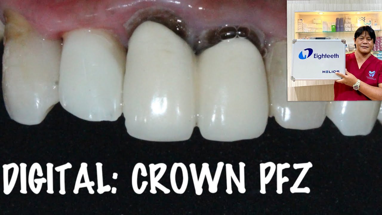 Pembuatan crown PFZ: Digital Impression menggunakan Helios 600 from ...