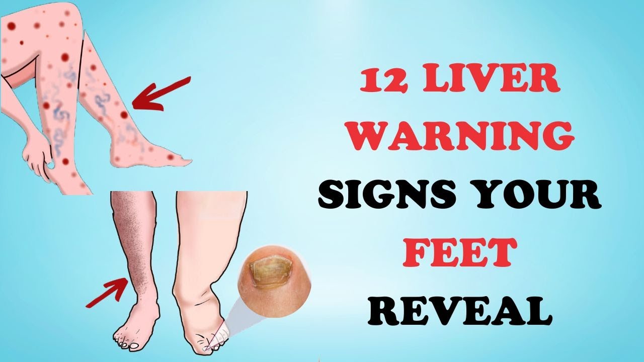 What Your Feet Can Tell You About Your Liver: 12 Warning Signs ...