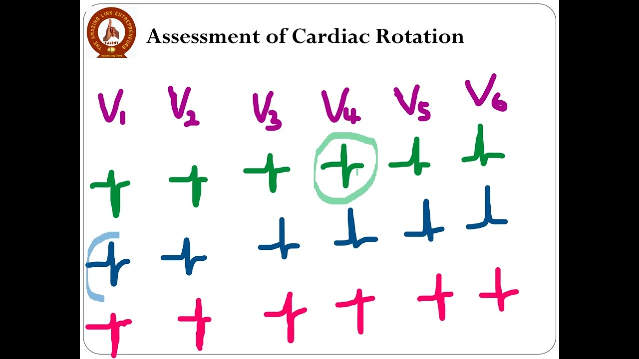 ECG Diagnosis of Cardiac Rotation by Oluwadare Ogunlade - YouTube