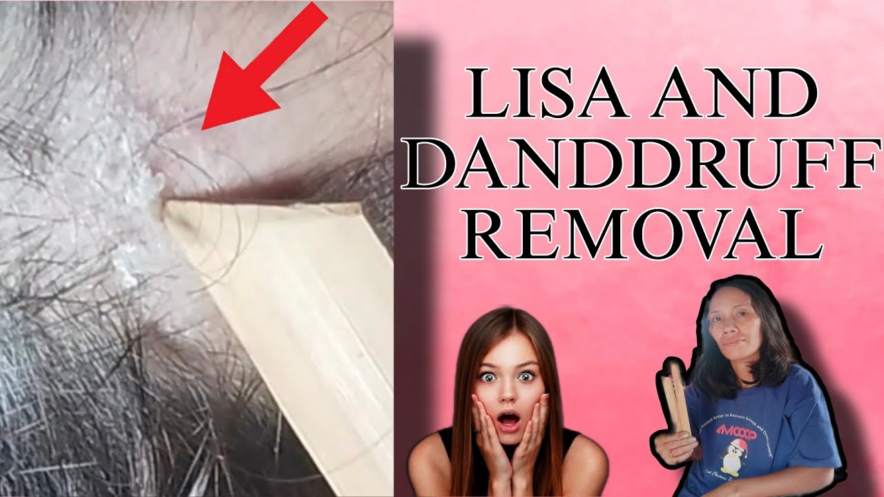 LISA AND DANDRUFF REMOVAL,SATISFYING NGA BA? - YouTube