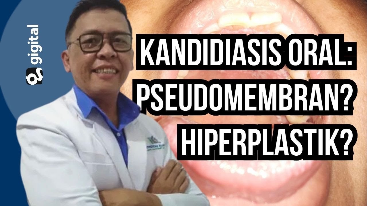 Kandidiasis oral pseudomembran ato hiperplastik? | Oral candidiasis ...
