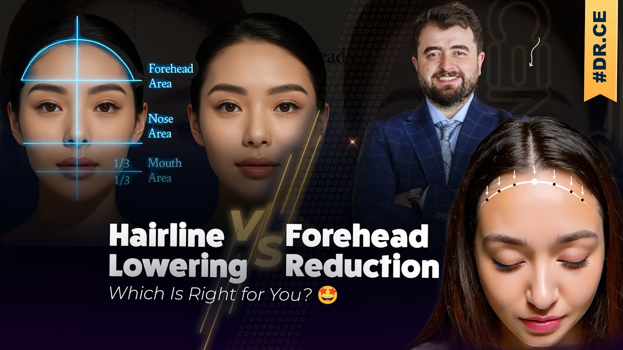 Forehead Reduction Surgery vs. Hairline Lowering with Hair Transplant ...