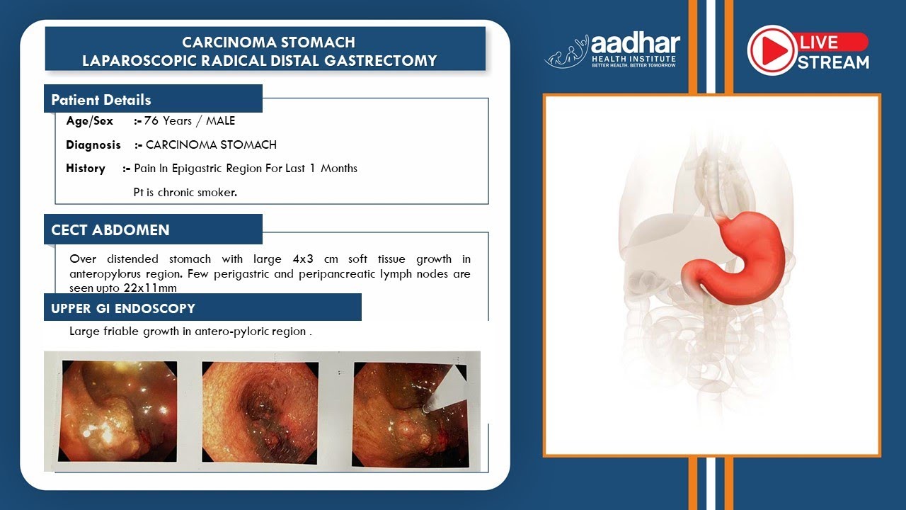 CARCINOMA STOMACH LAPAROSCOPIC RADICAL DISTAL GASTRECTOMY - YouTube