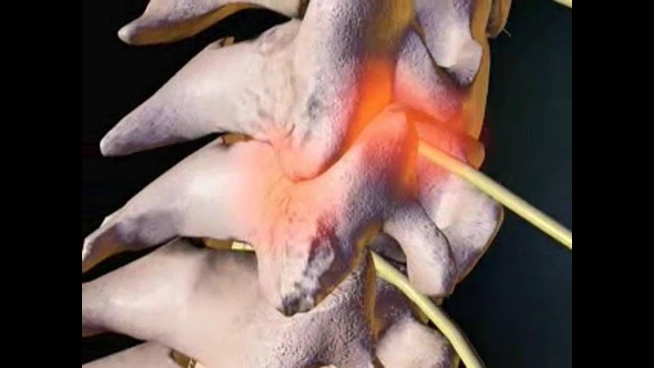 Facet joint block animation - YouTube