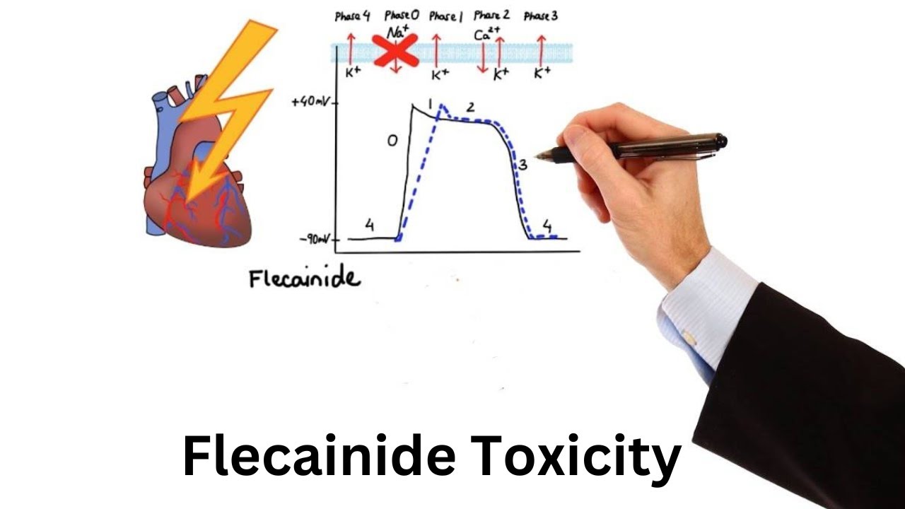 Flecainide toxicity: A Case Study - YouTube