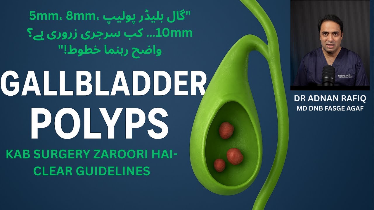 “Gallbladder Polyp 5mm, 8mm, 10mm… Kab Surgery Zaroori Hai? Clear ...