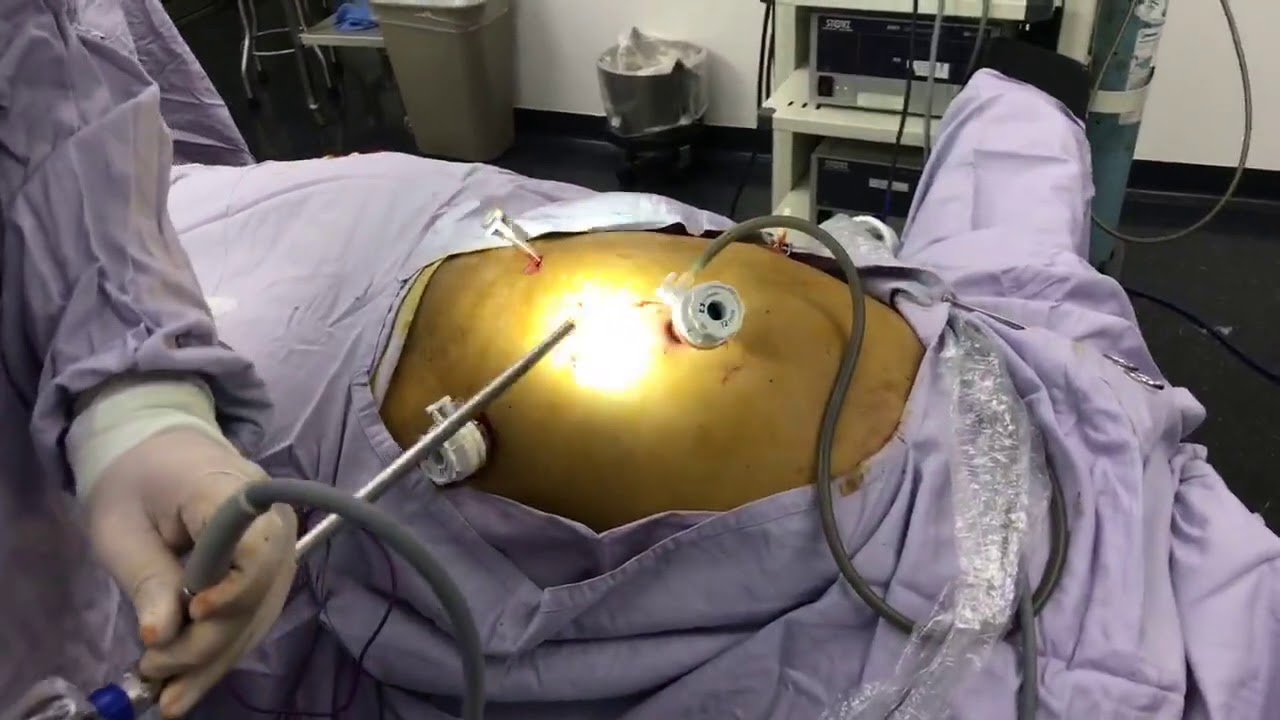 Apendicectomía laparoscópica en vivo 2018 - YouTube