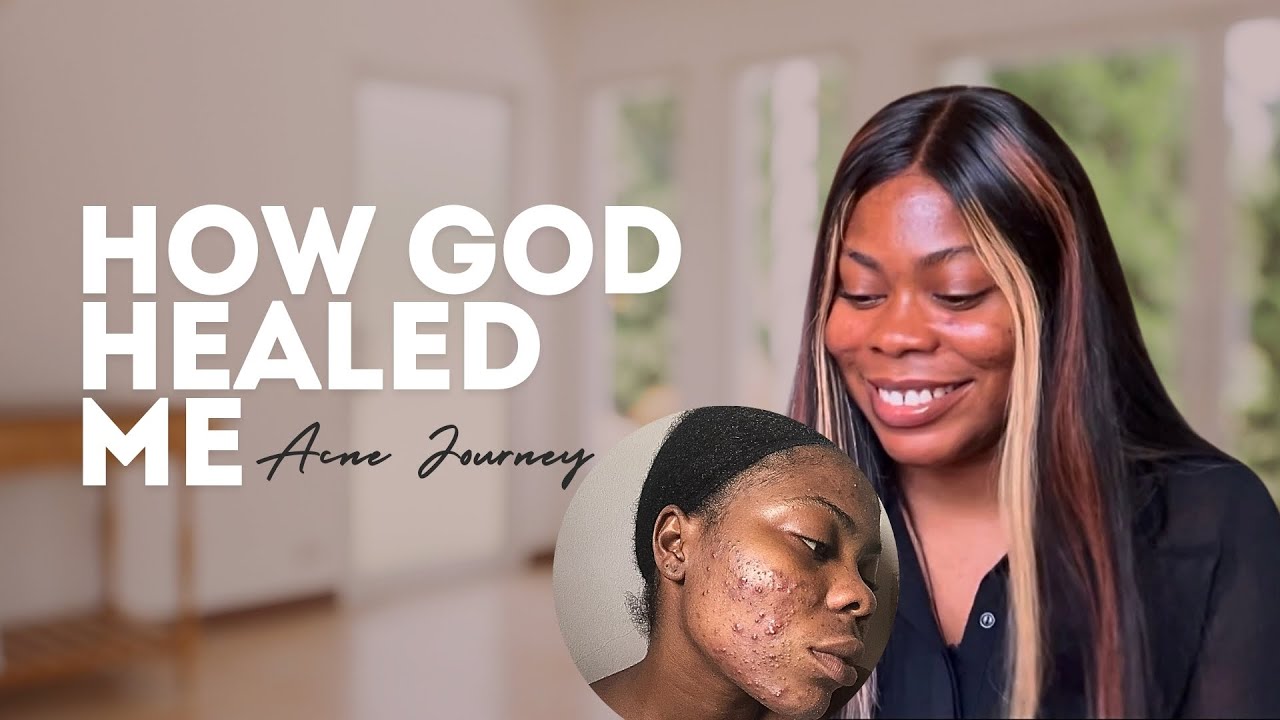 How God Healed Me | My Acne Journey Before & After - YouTube
