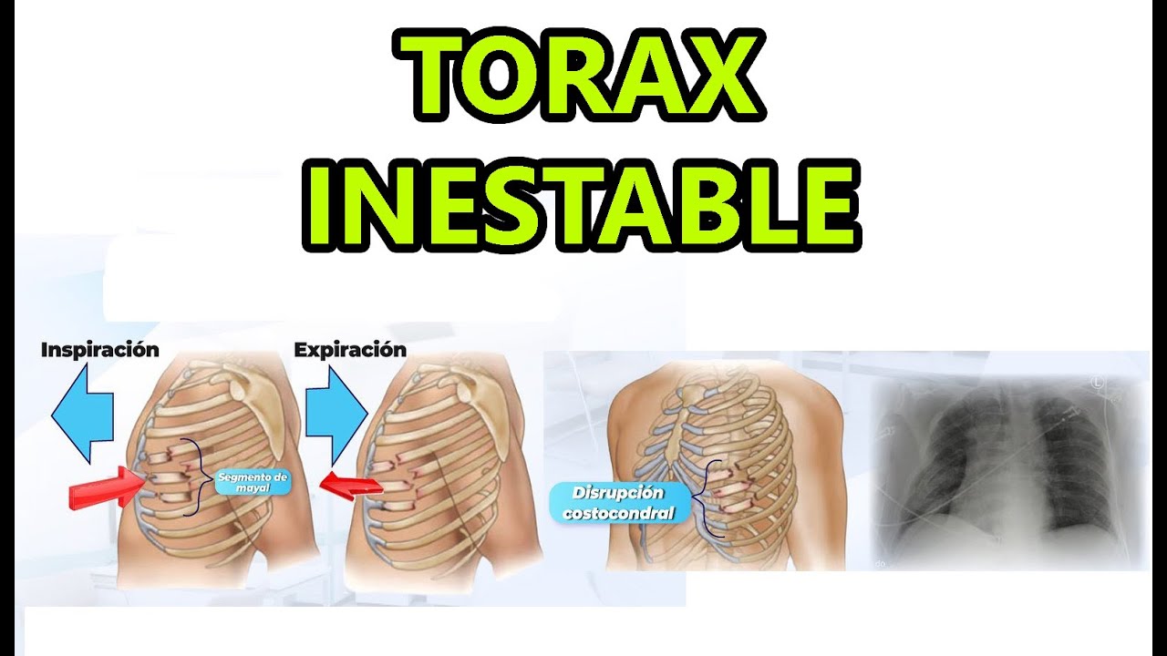 🔴 TORAX INESTABLE - YouTube