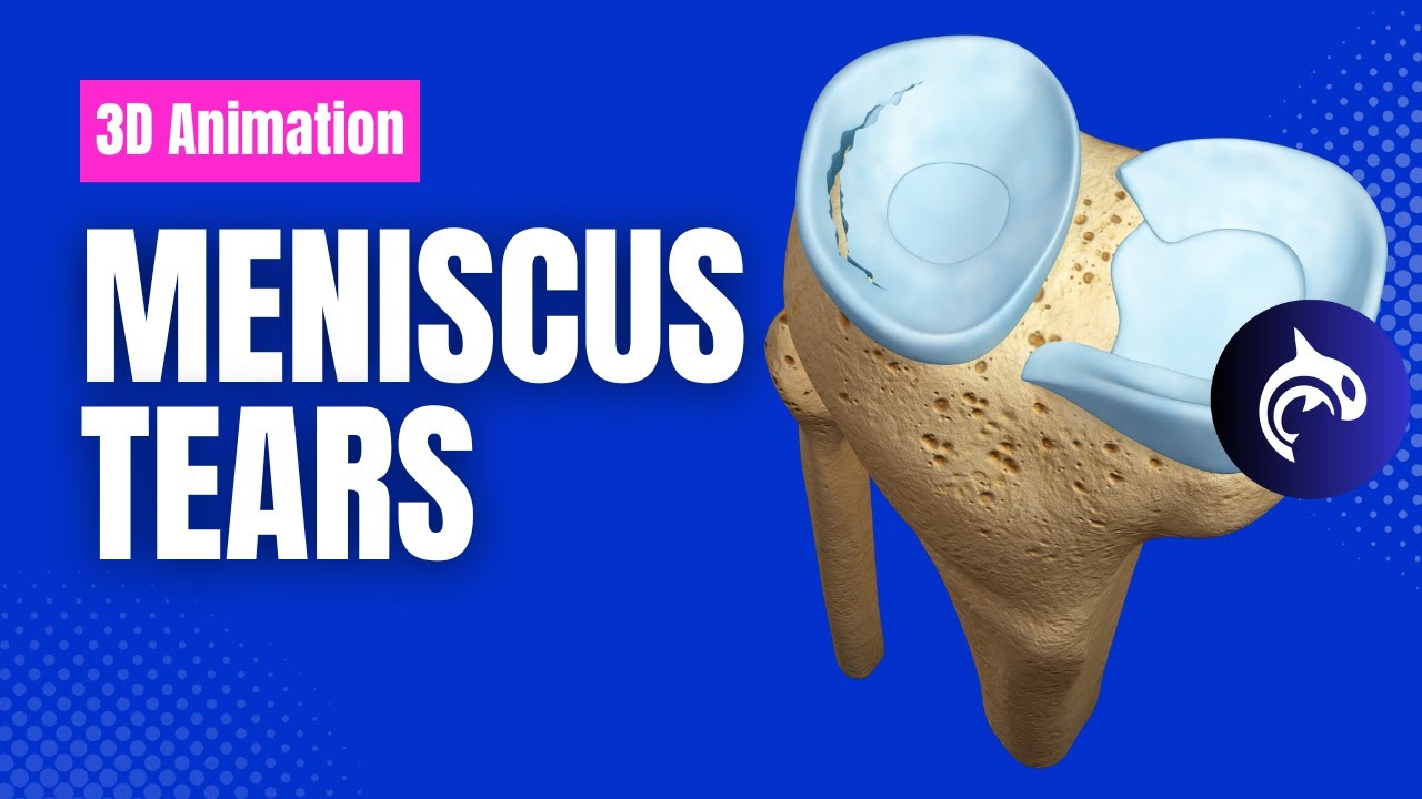 Meniscus Tears - Condition, Treatment, and Surgery - 3D Animation - YouTube