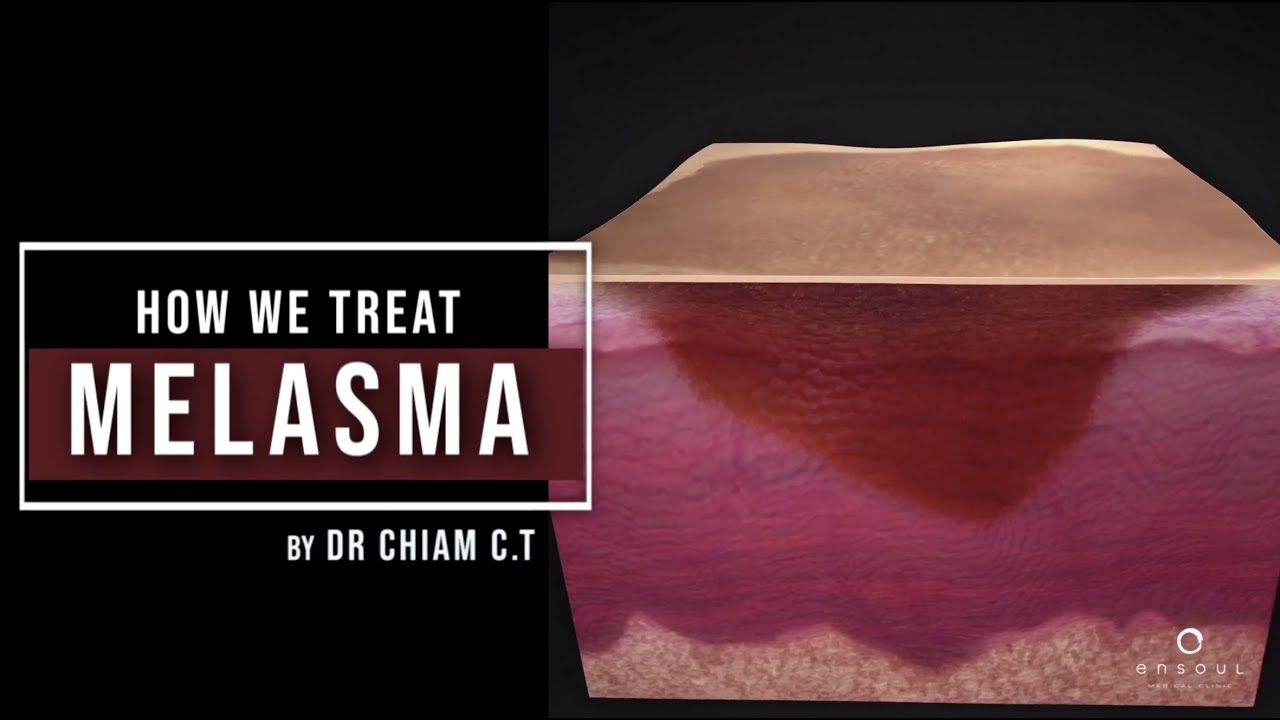 My 4-Step Approach to Treating Melasma | Dr Chiam Chiak Teng - YouTube