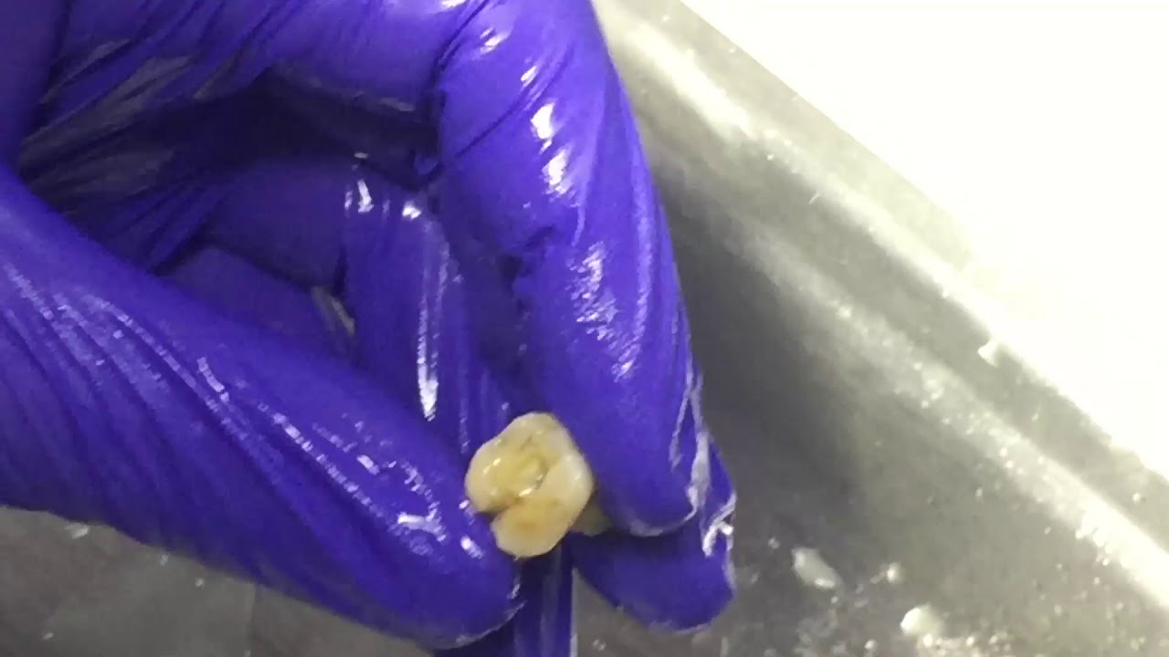 Endo Demo on Access Opening Upper Molar ||| KSU - YouTube