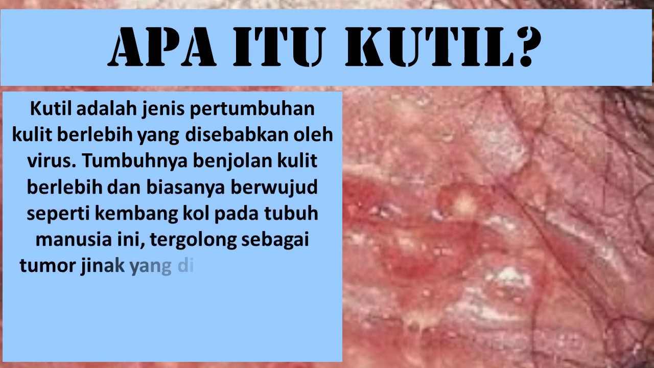 WASPADA PENYAKIT KUTIL KELAMIN MENULAR BINTIK KUTIL DI MIS V WANITA ...