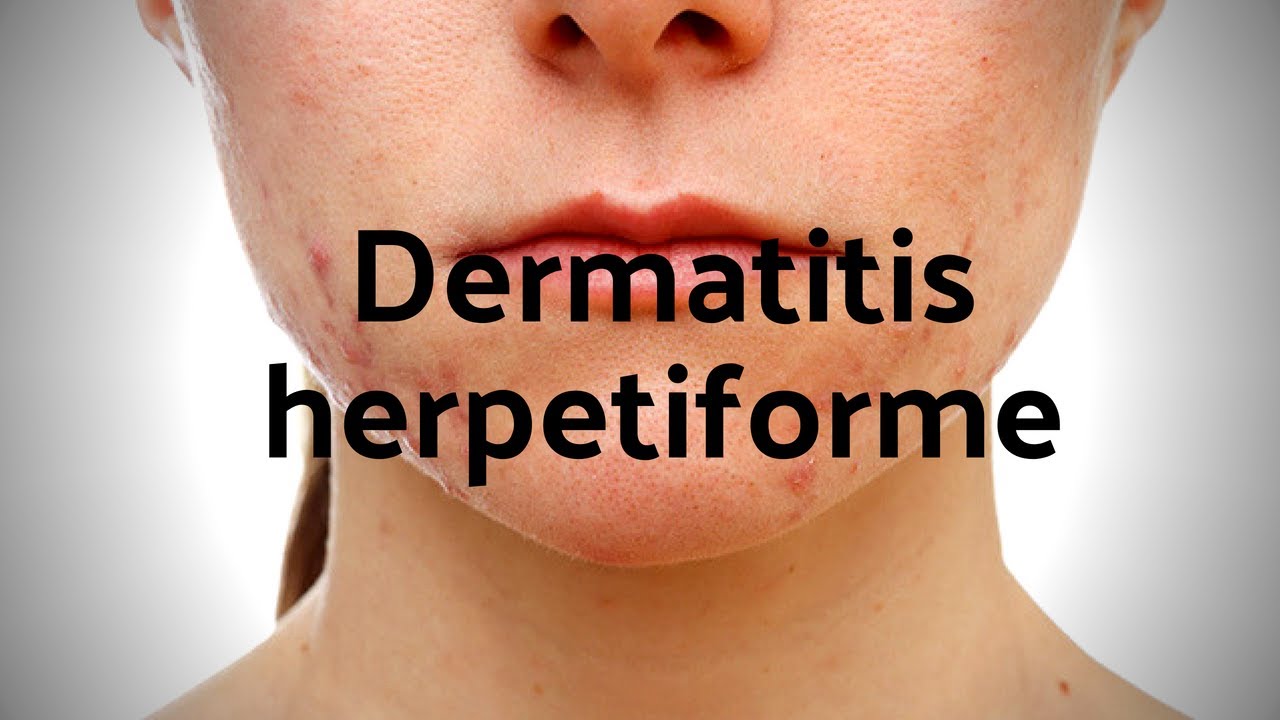 Dermatitis herpetiforme - YouTube