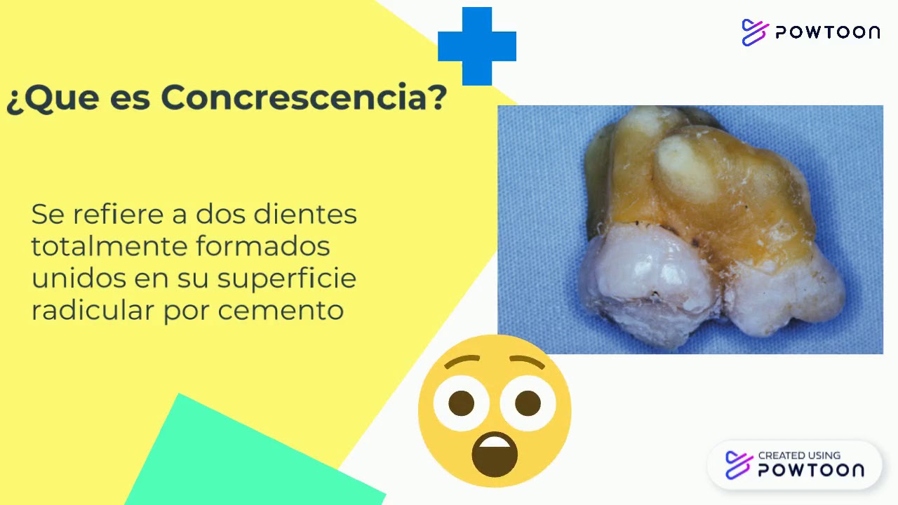 Concrescencia e Hipercementosis - YouTube