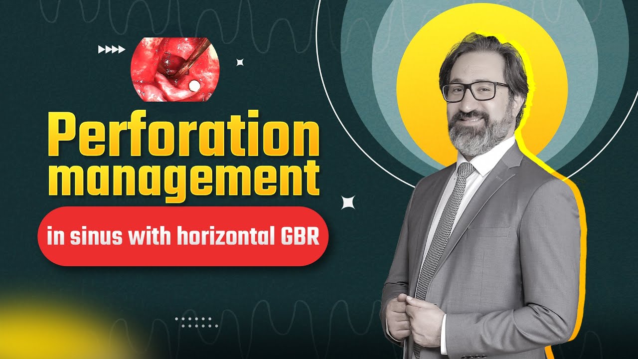 Perforation management in sinus with horizontal GBR - YouTube
