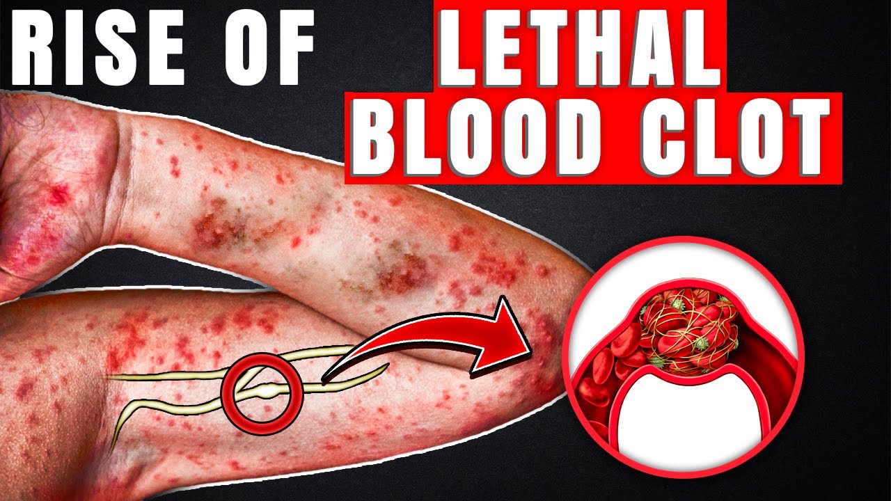 Global Crisis: Unstoppable Surge of Deadly Blood Clots Sweeping the ...