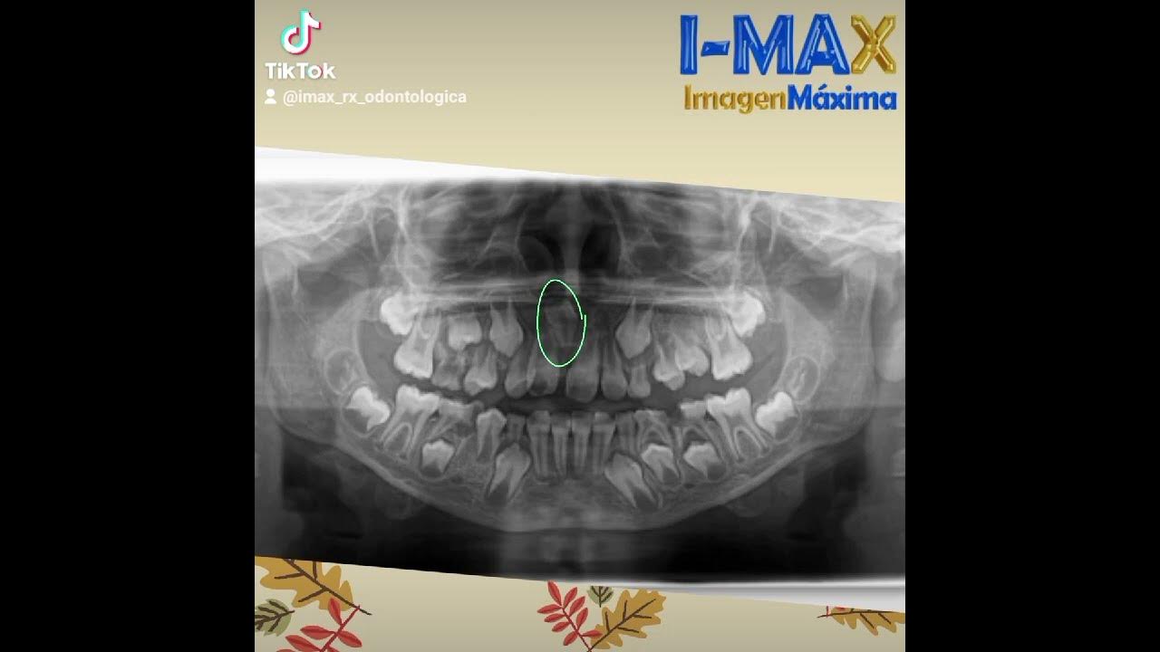 Radiografia PanorÁmica En DenticiÓn Mixta Youtube