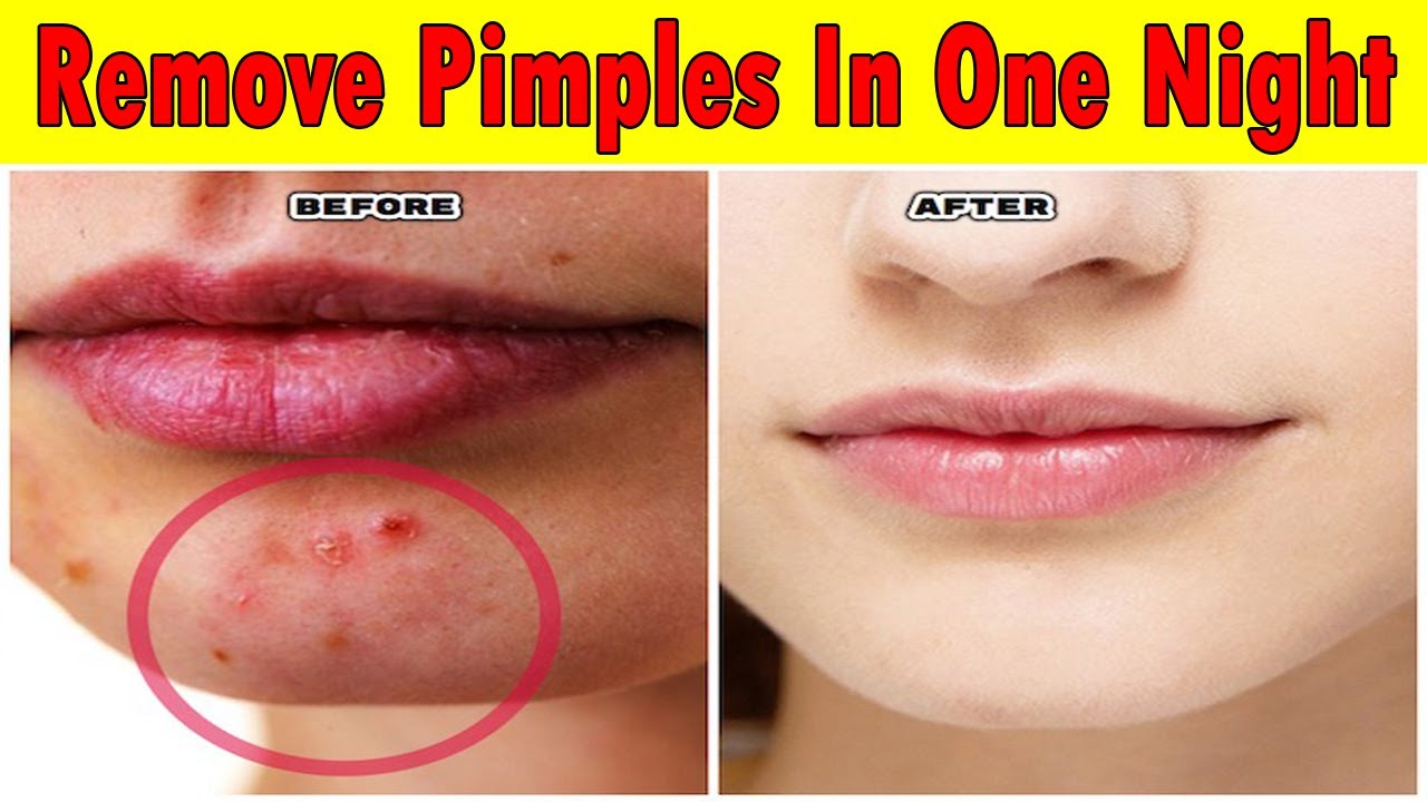 How To Remove Pimples || Best Home Remedy To Get Rid of Pimples - YouTube