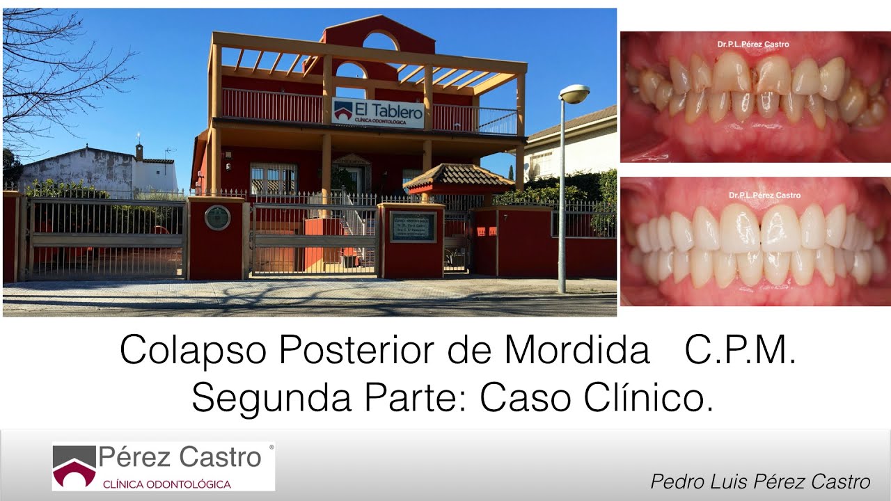 COLAPSO POSTERIOR DE MORDIDA. SEGUNDA PARTE. CASO CLÍNICO - YouTube