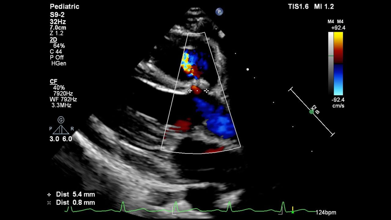 Basic echocardiography(심초음파 기본)- Perimembranous VSD c aneurysmal formation - YouTube