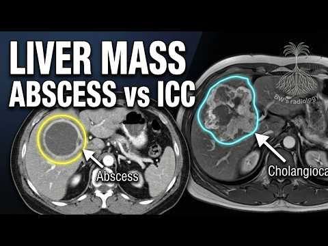Liver Mass: Abscess vs Mass-Forming Intrahepatic Cholangiocarcinoma