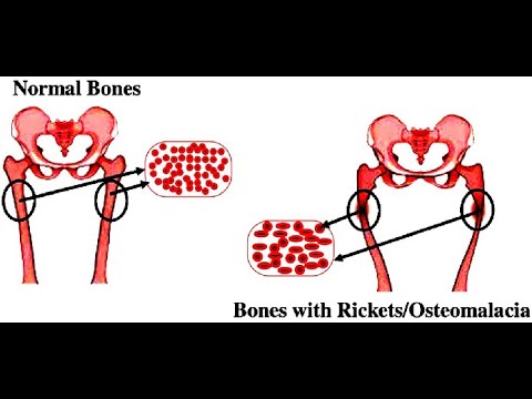 Osteomalacia and Rickets Metabolic Bone Disease ; Pathogenesis and ...