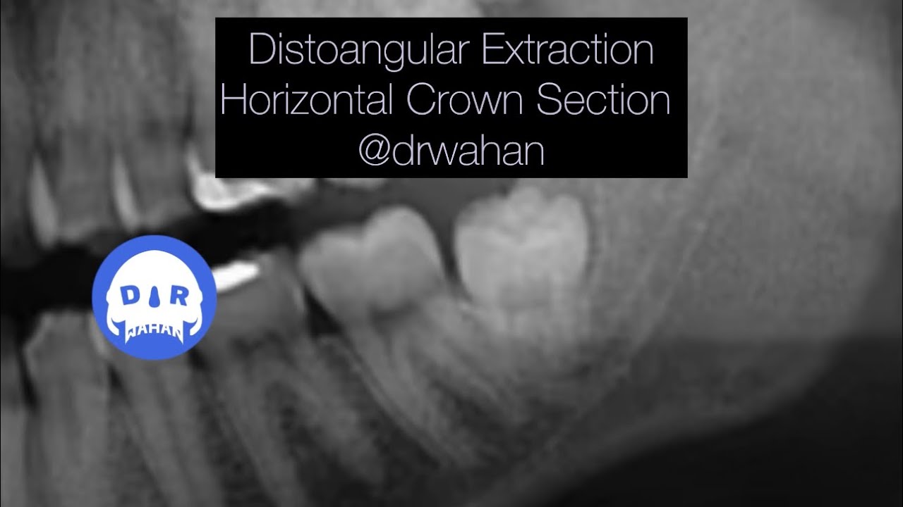Distoangular Wisdom Tooth Extraction with Horizontal Crown Sectioning ...