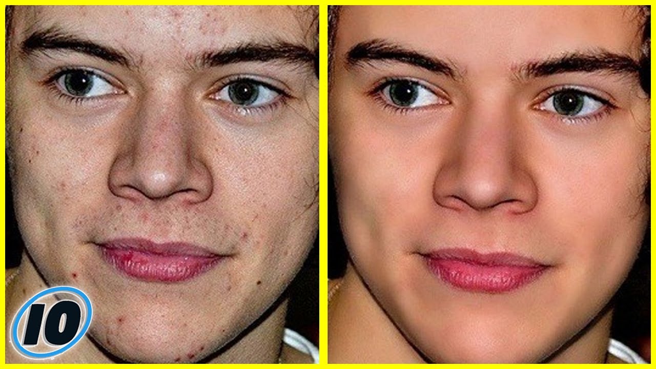 Top 10 Celebrities That Struggle With Acne - Part 2 - YouTube