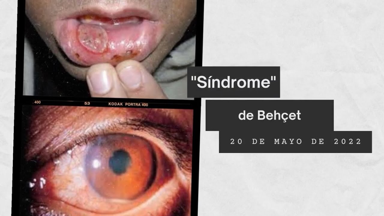 Síndrome de Behçet día mundial de la enfermedad - YouTube
