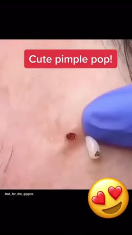 point noir extraction extraction de points noirs 79 - YouTube