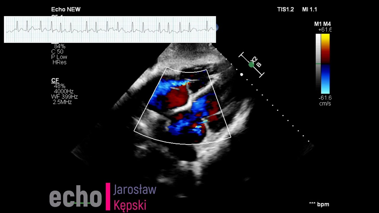 Echocardiography during arrhythmia, Atrial Fibrillation AF, Heart ...