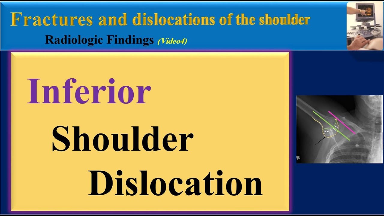 Identifying Inferior Shoulder Dislocation Cases In Radiology - YouTube