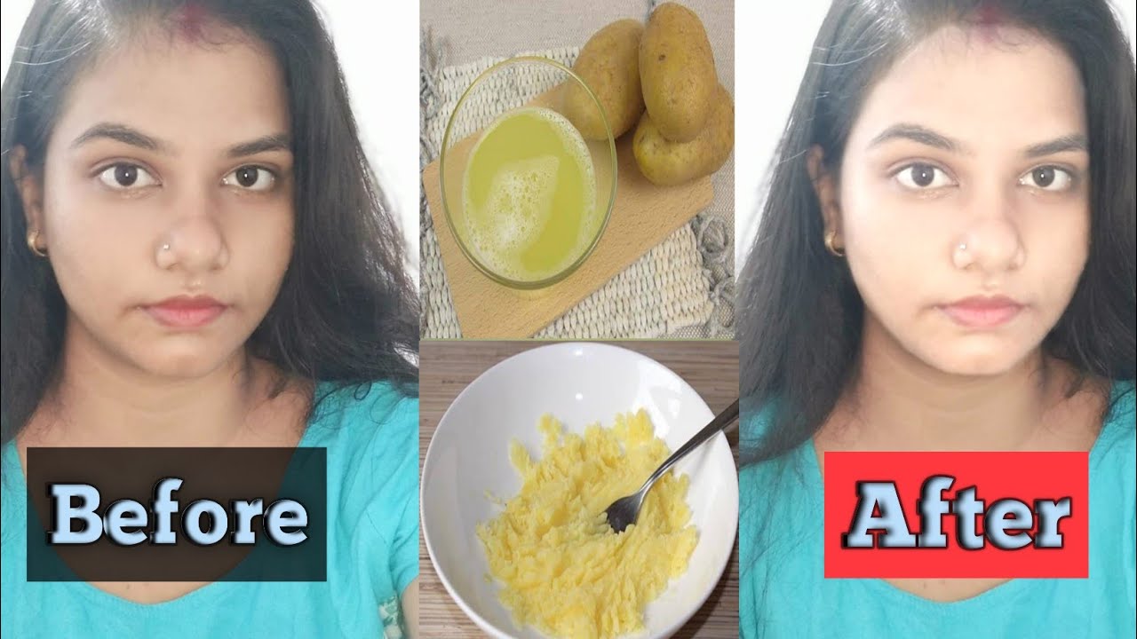 Potato Facial for Skin Whitening | Potato Face mask for Dark Sports ...