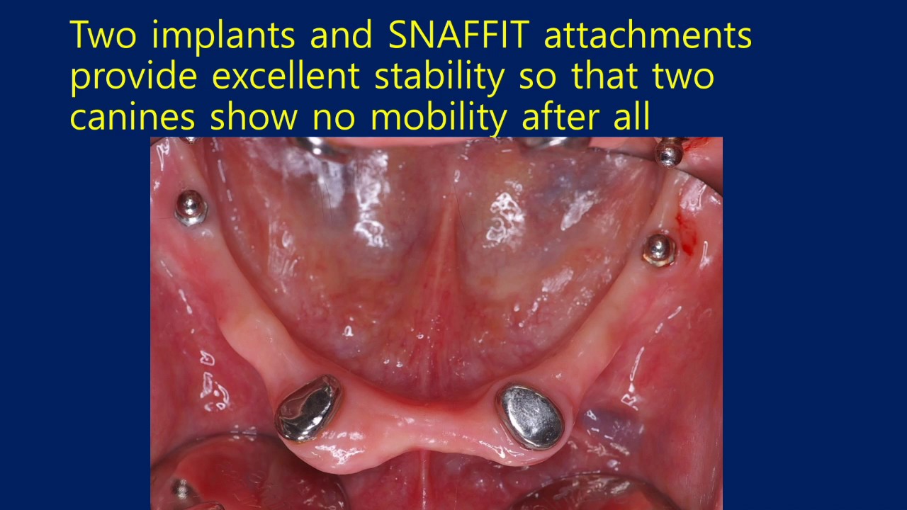 SNAFFIT Overdenture over two natural teeth metal caps and two implants ...
