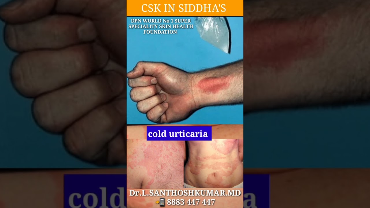 Cold Urticaria Foundation