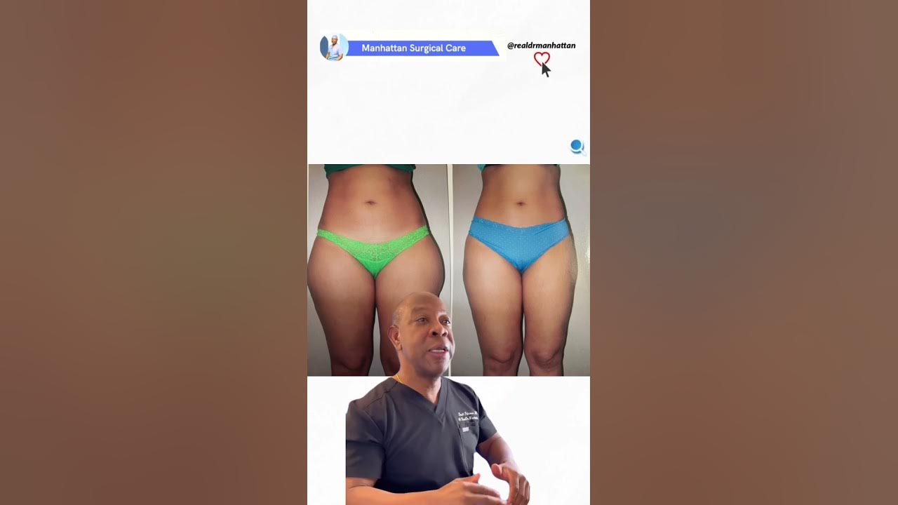 Lipo Of Lateral Thighs And Inner Thighs Youtube