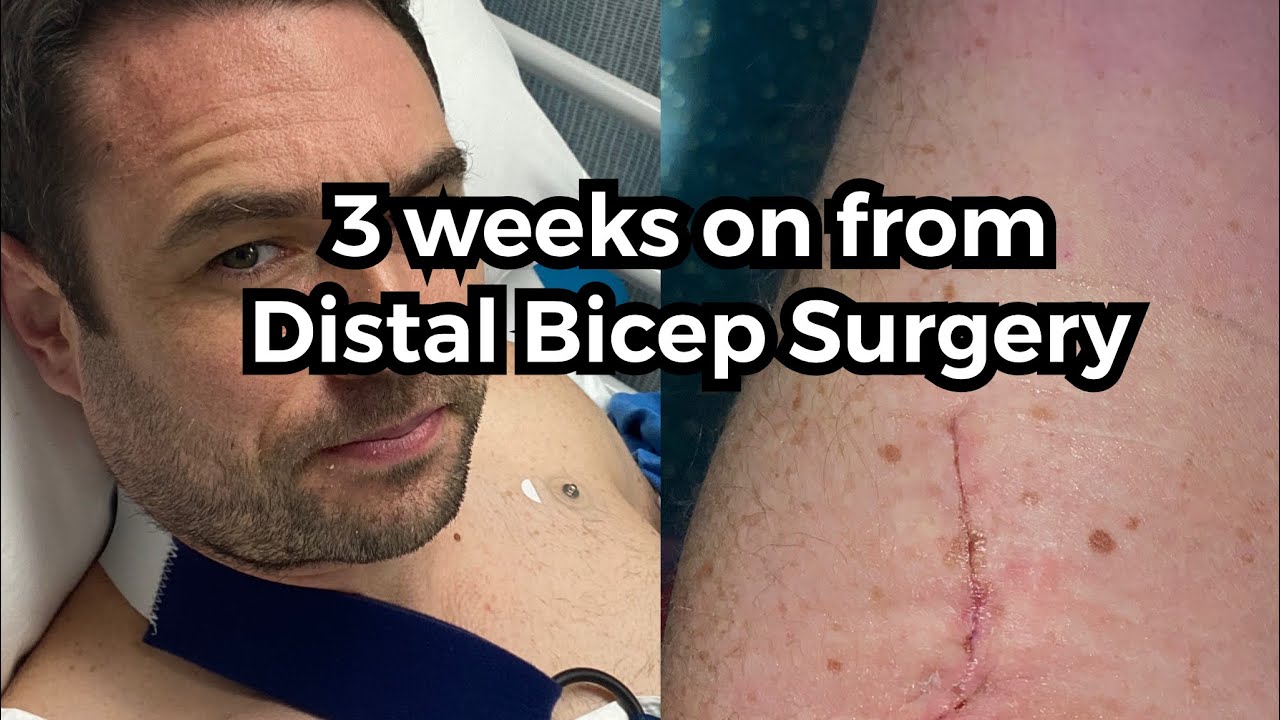 3 weeks post distal bicep surgery - YouTube