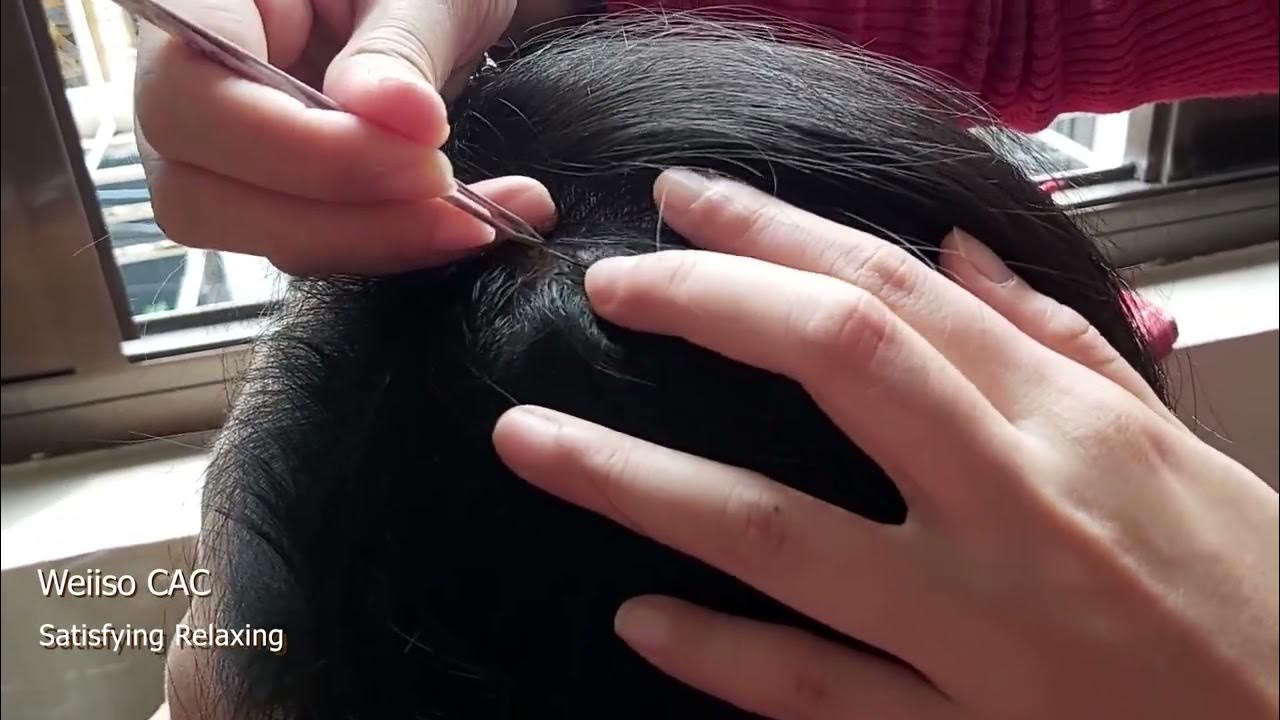 Satisfying Relaxing Cabut Uban Mamer #9 - YouTube