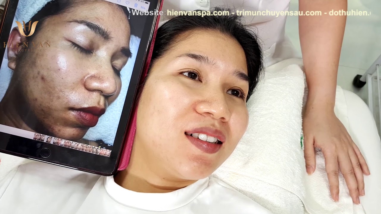 Review customers after acne treatment at Hien Van Spa-Phương Thảo-367 ...
