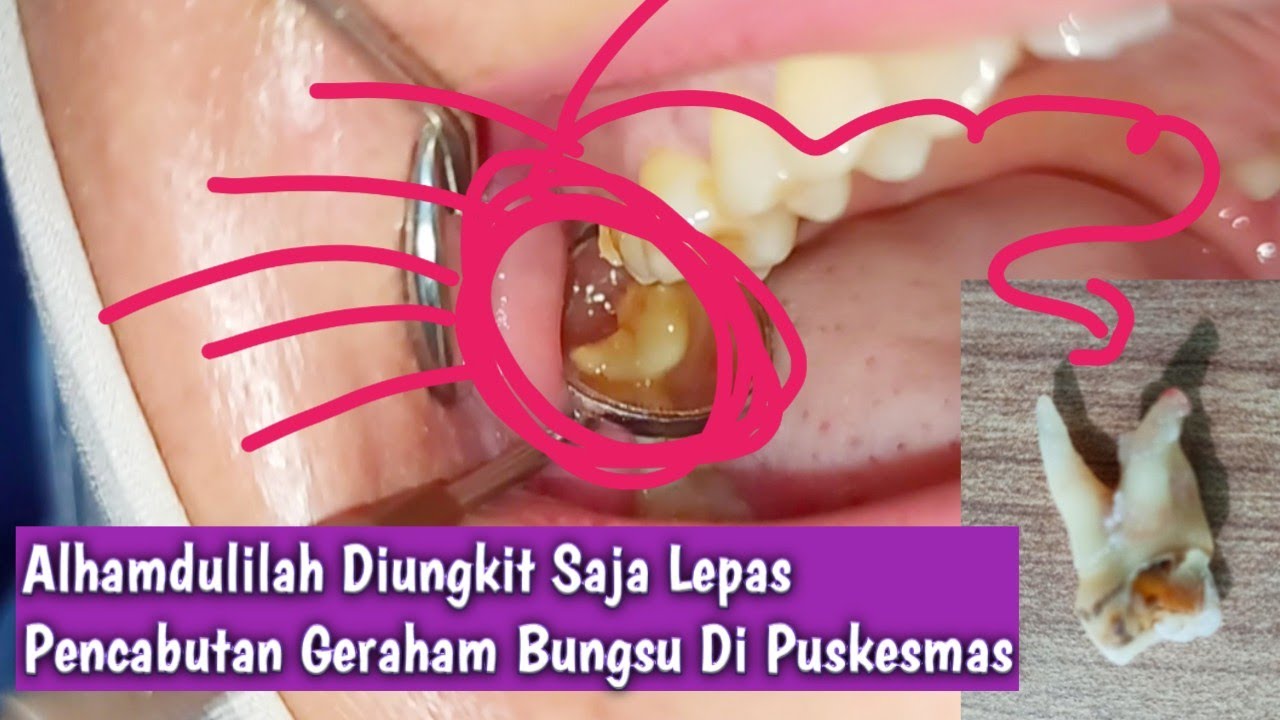 Geraham Bungsu Atas Berlubang Tertutup Polip Diungkit Saja Lepas ...