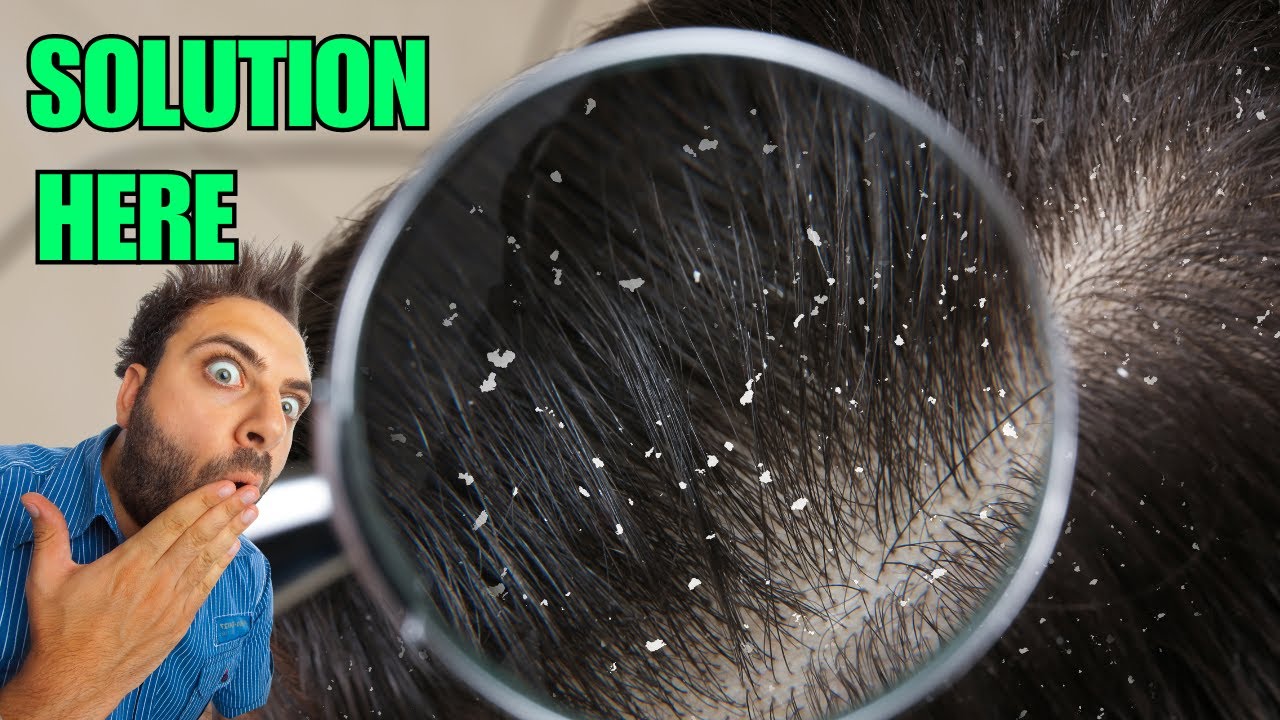 What causes dandruff, and how do you get rid of it? - Thomas L. Dawson ...