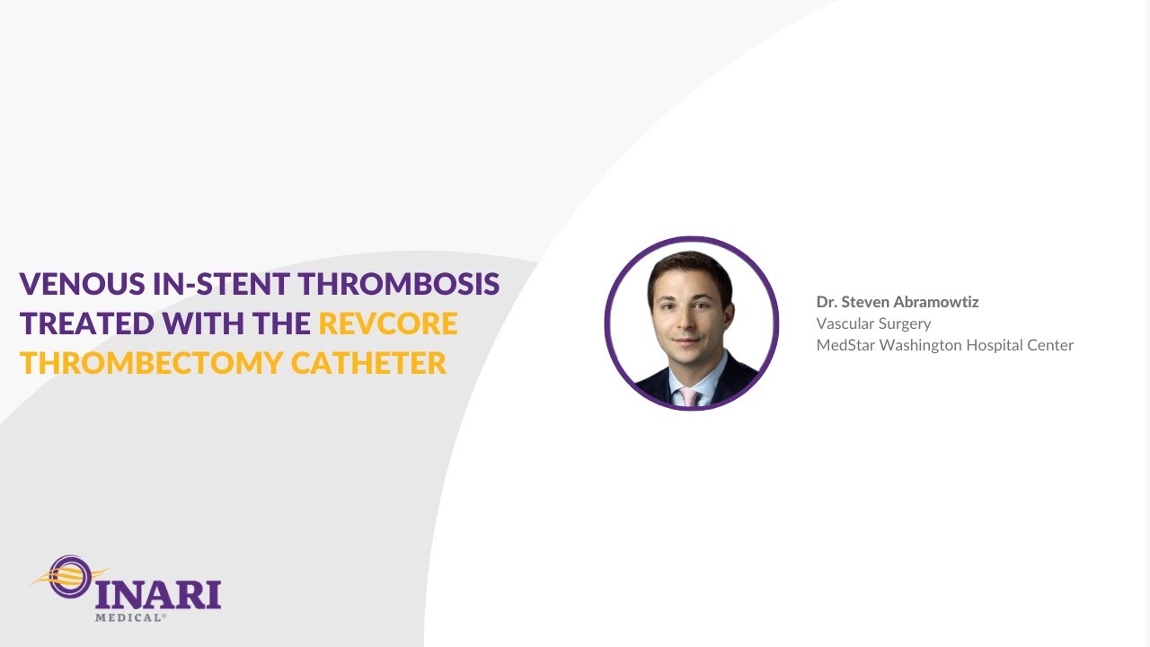 Venous in Stent Thrombosis Treated with the RevCore Thrombectomy ...