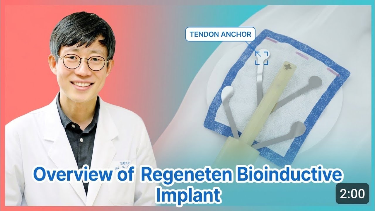 Regeneten Bioinductive Implant: Revolutionizing Rotator Cuff Repair ...