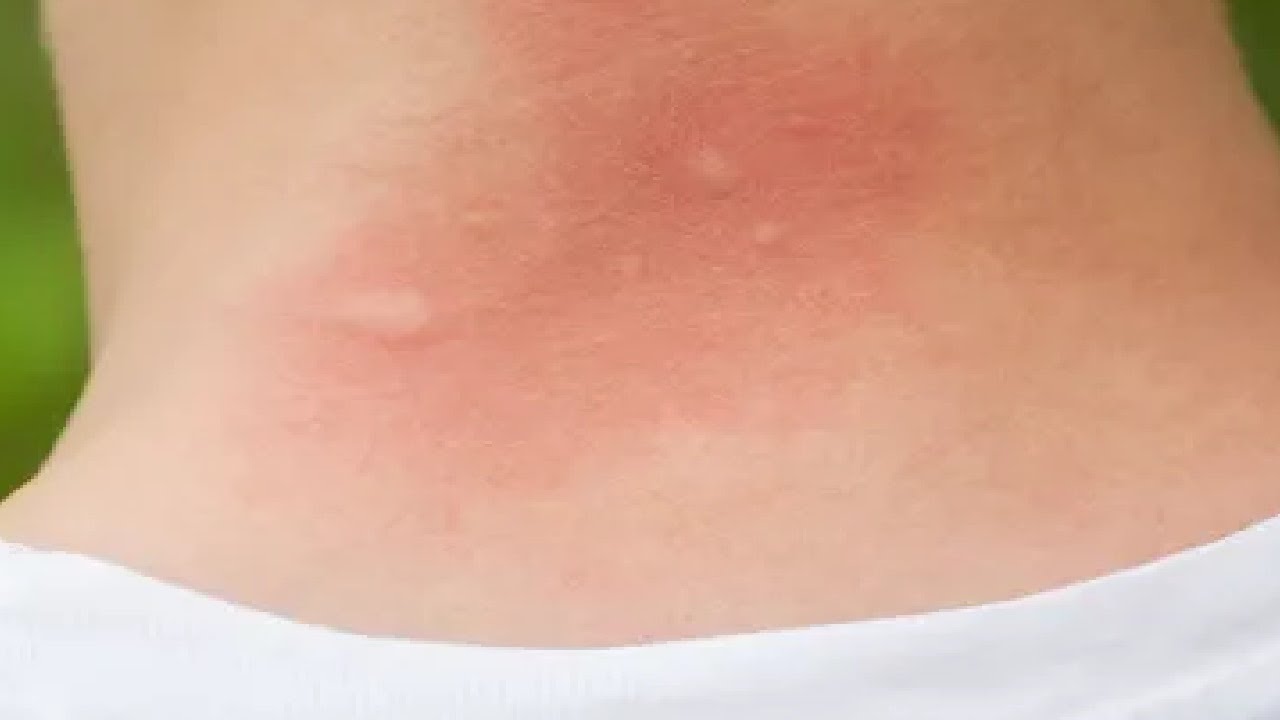 how to get rid of mosquito bites on face overnight - YouTube