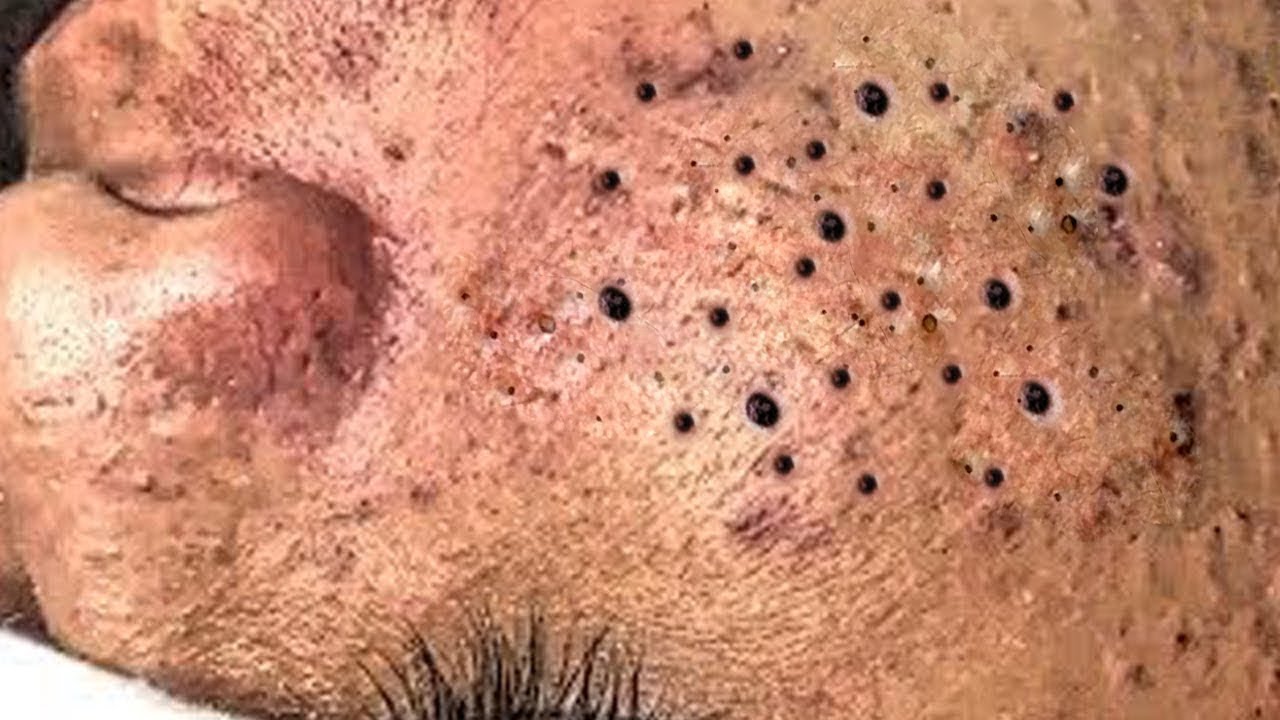 Big Cystic Acne Blackheads Extraction Blackheads & Milia, Whiteheads ...