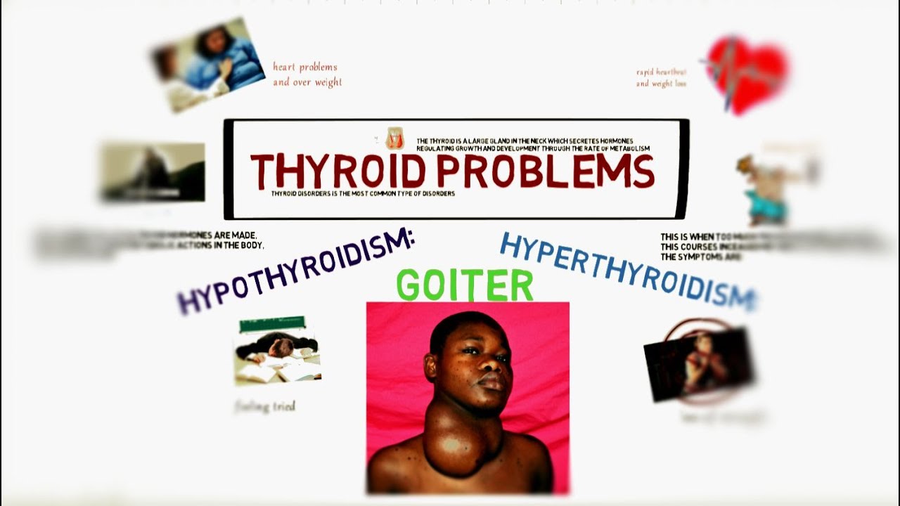 Thyroid Disorders Explained: Goiter, Hyperthyroidism, and ...